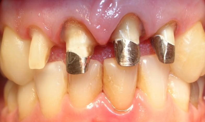 Perno muñón colado - juanbalboa.com