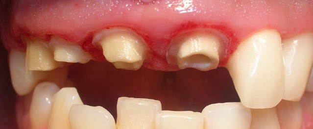 Perno muñón colado - juanbalboa.com