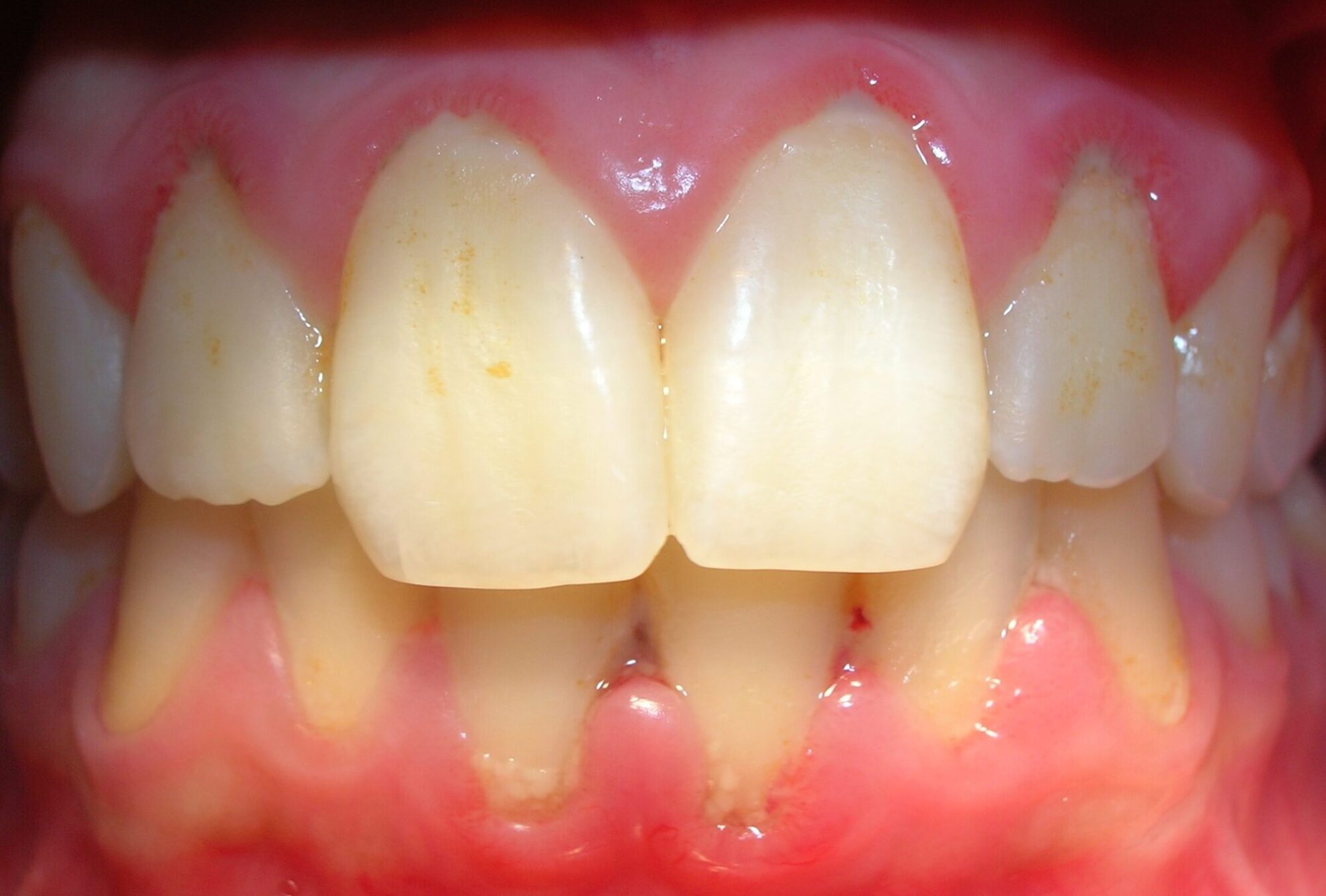 Gingivitis marginal crónica. ¿Por qué sangran las encías? - juanbalboa.com