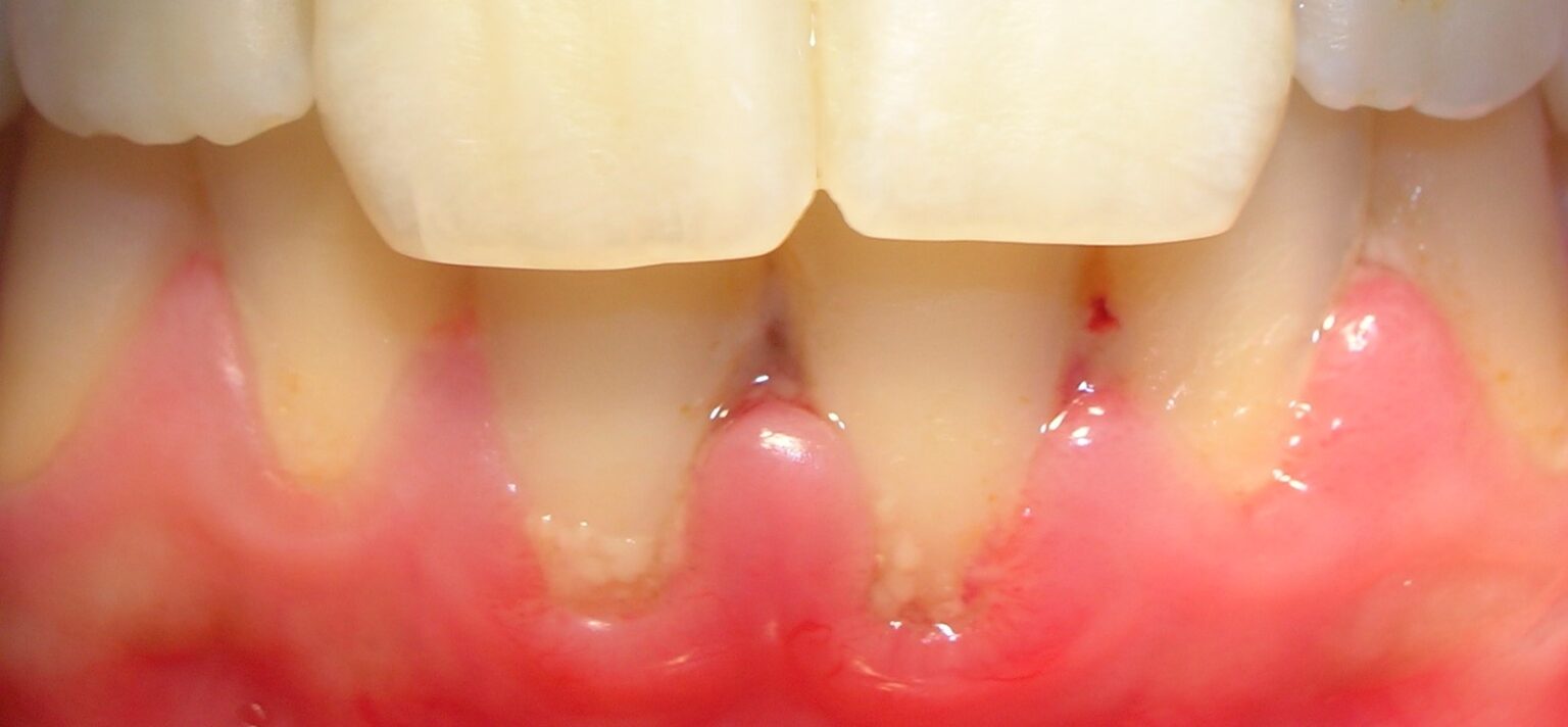 Gingivitis marginal crónica. ¿Por qué sangran las encías? - juanbalboa.com