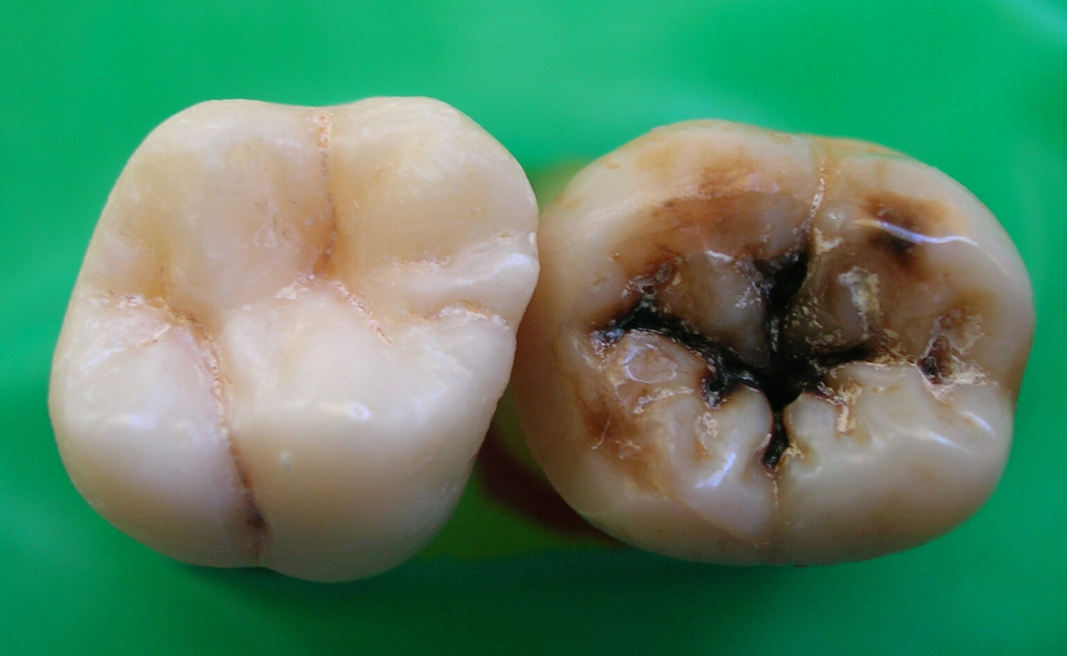 Caries dental. ¿Qué son y cómo se previenen? - juanbalboa.com