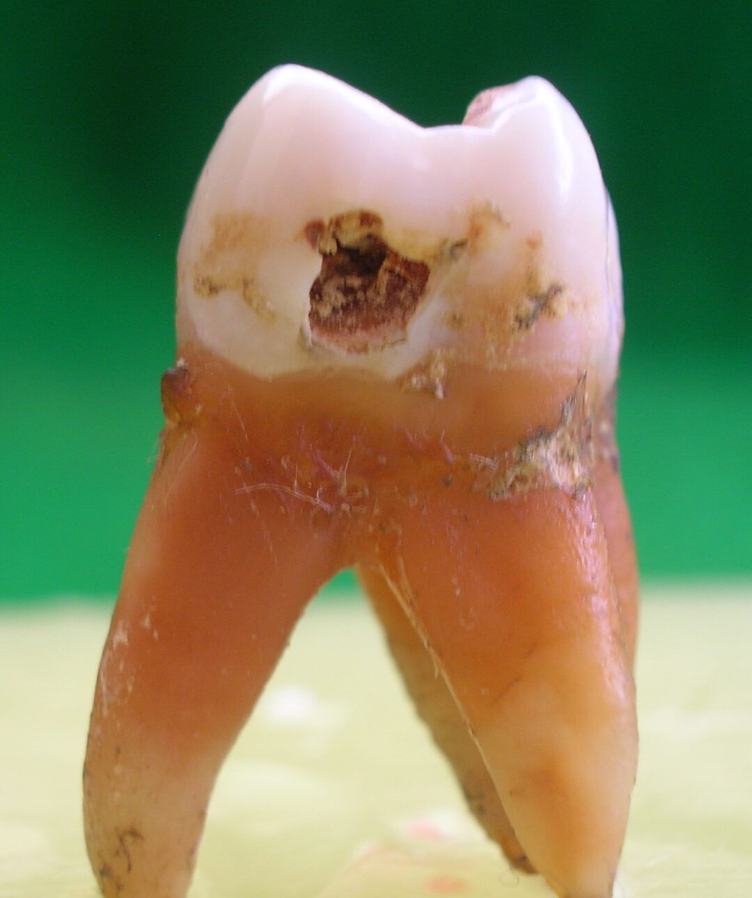 Caries dental. ¿Qué son y cómo se previenen? - juanbalboa.com