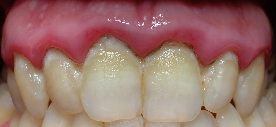 Cálculo dental, el sarro de los dientes - juanbalboa.com