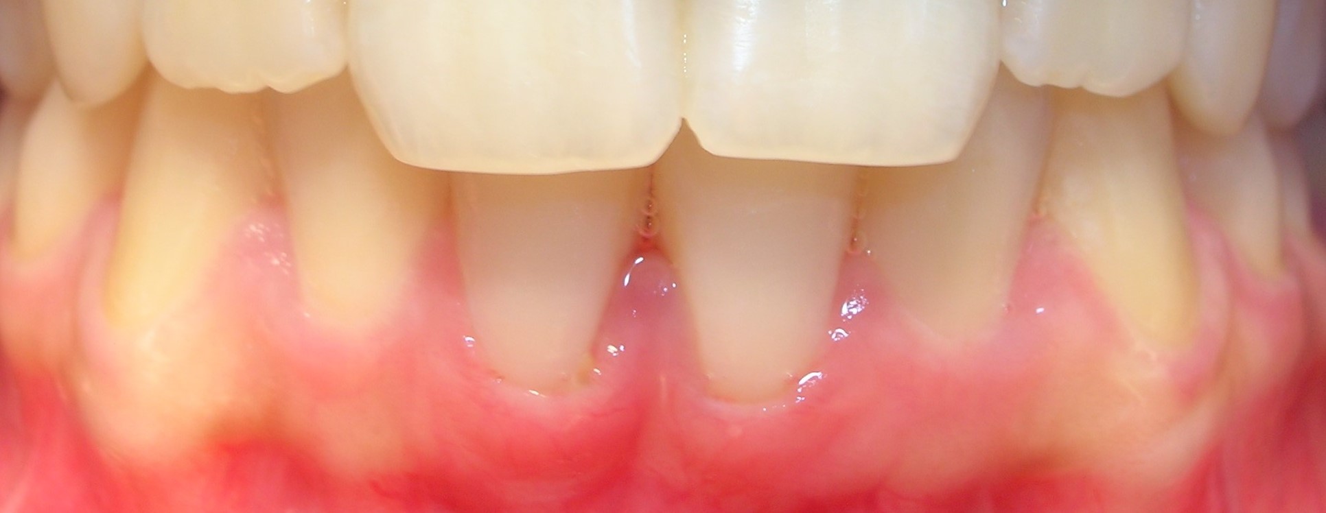 Cálculo dental, el sarro de los dientes - juanbalboa.com