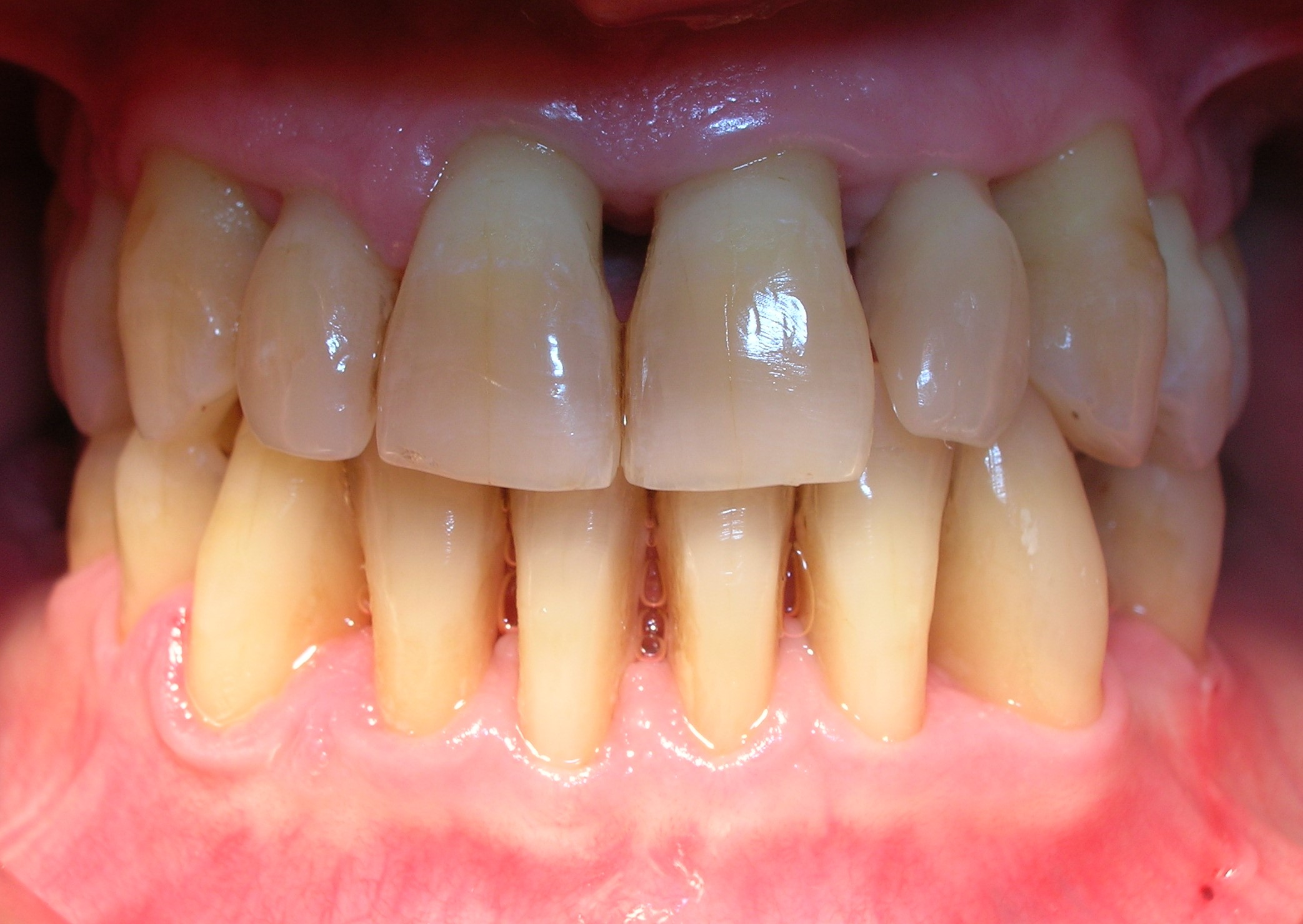 Cálculo dental, el sarro de los dientes - juanbalboa.com