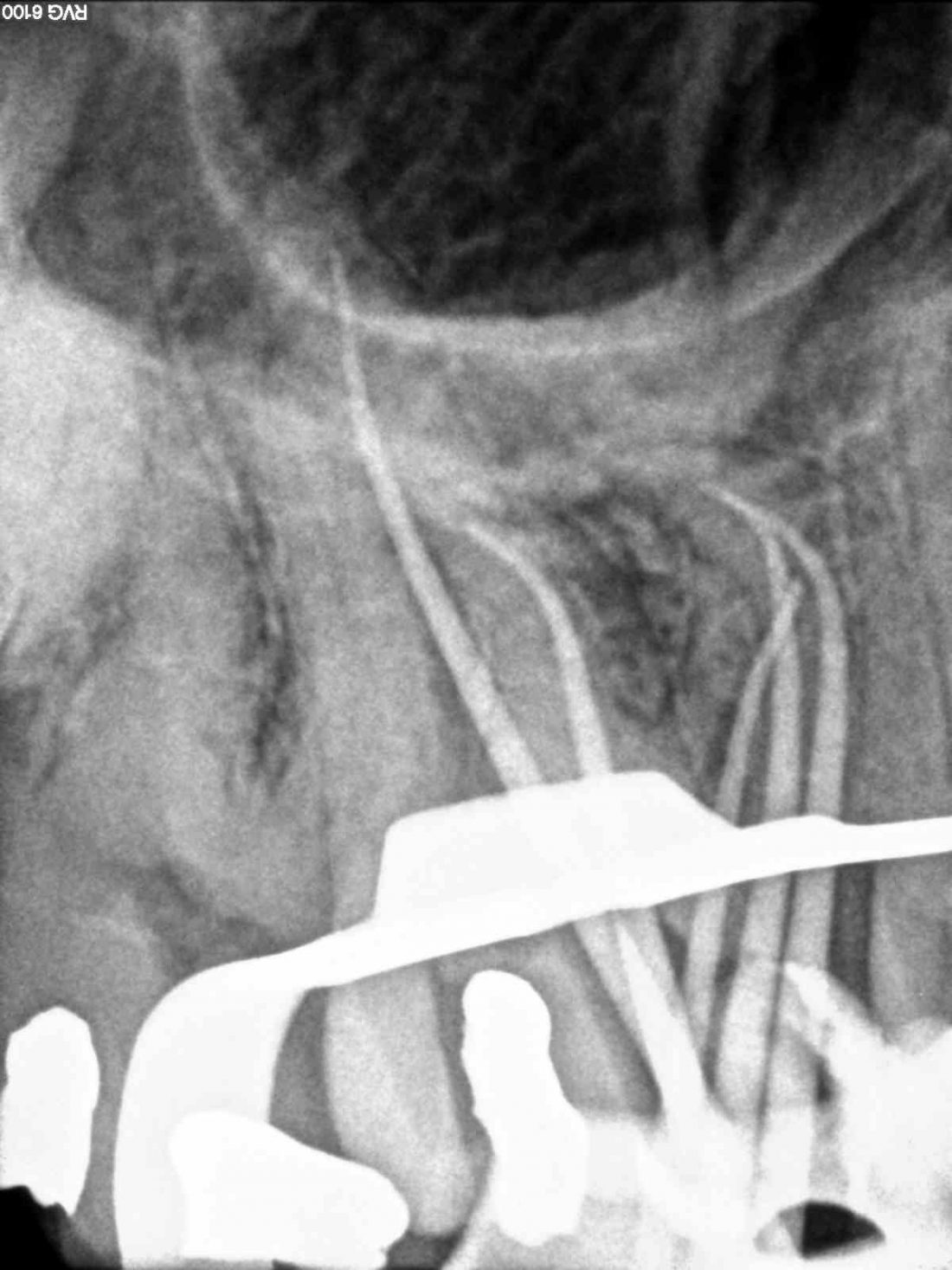 Endodoncia mal hecha, fracaso y frustración - juanbalboa.com