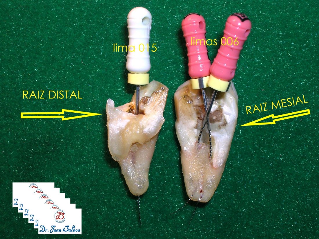 Endodoncia mal hecha, fracaso y frustración - juanbalboa.com