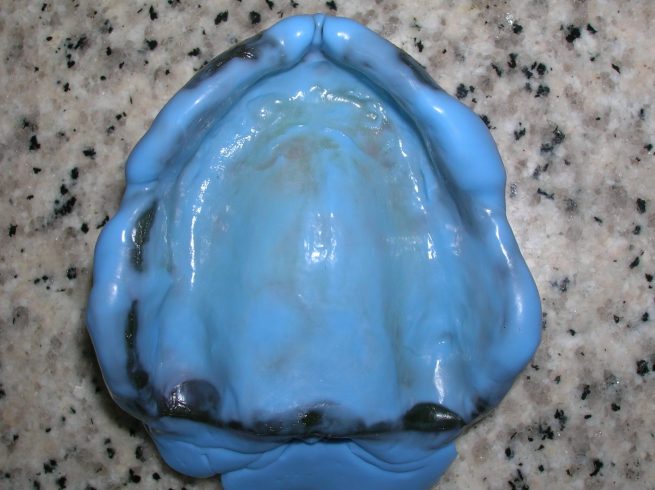 Impresión para prótesis completa superior mucosoportada - juanbalboa.com