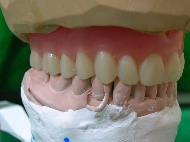 Impresión para prótesis completa superior mucosoportada - juanbalboa.com